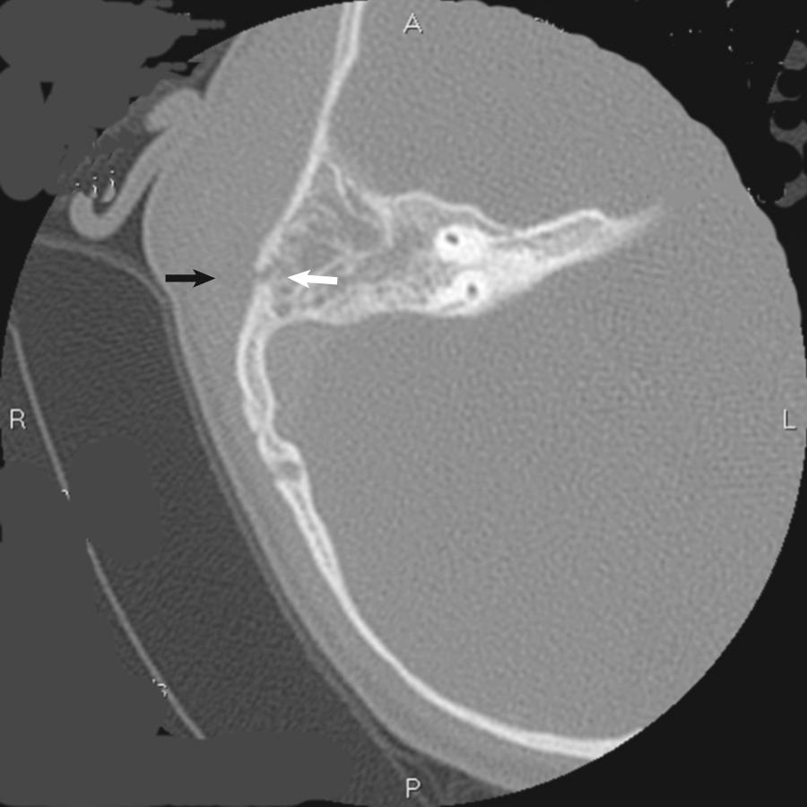 Complications of Temporal Bone Infections - Clinical Tree