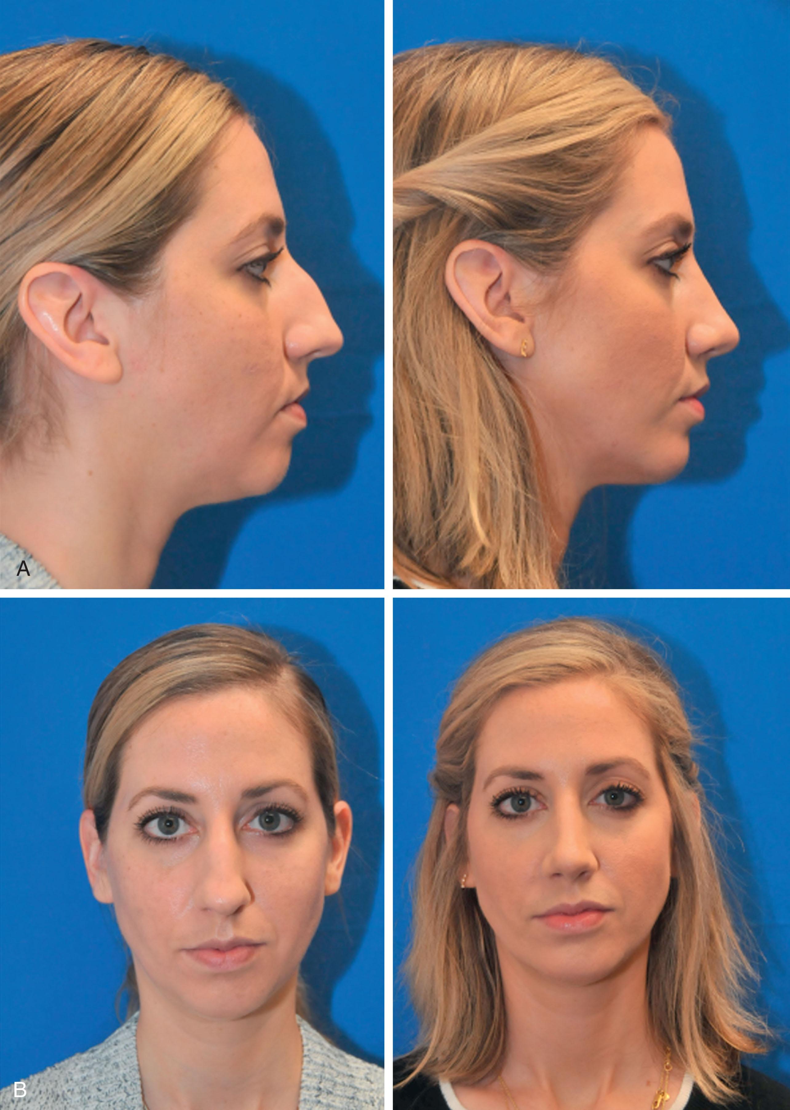 Composite Hump Resection - Clinical Tree