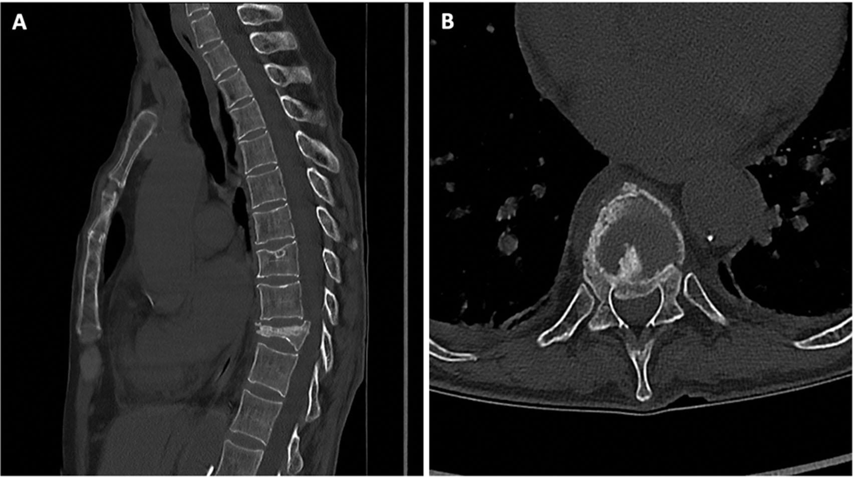 Compression fracture with back pain - Clinical Tree