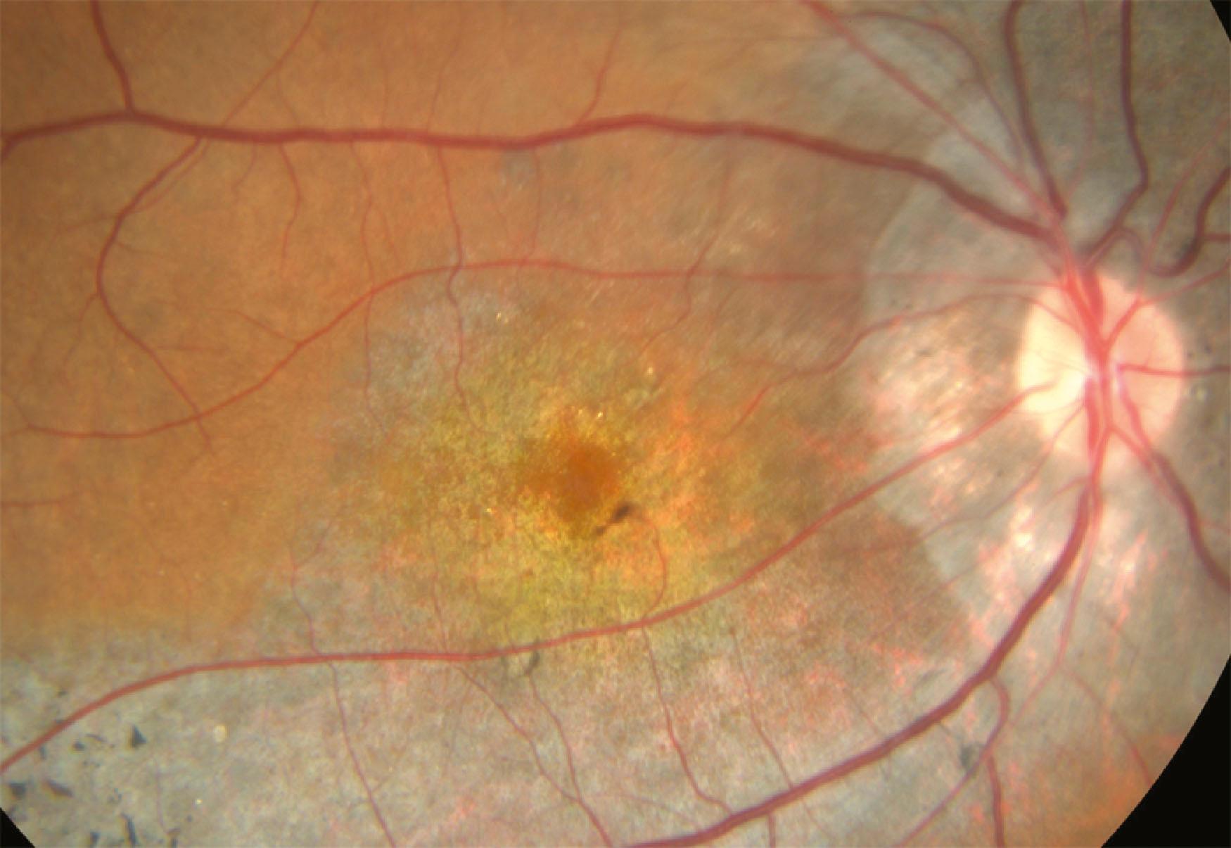 Cone Dystrophy - Clinical Tree