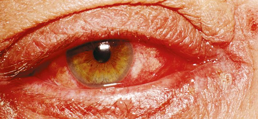 Conjunctivitis : (Pink Eye) - Clinical Tree