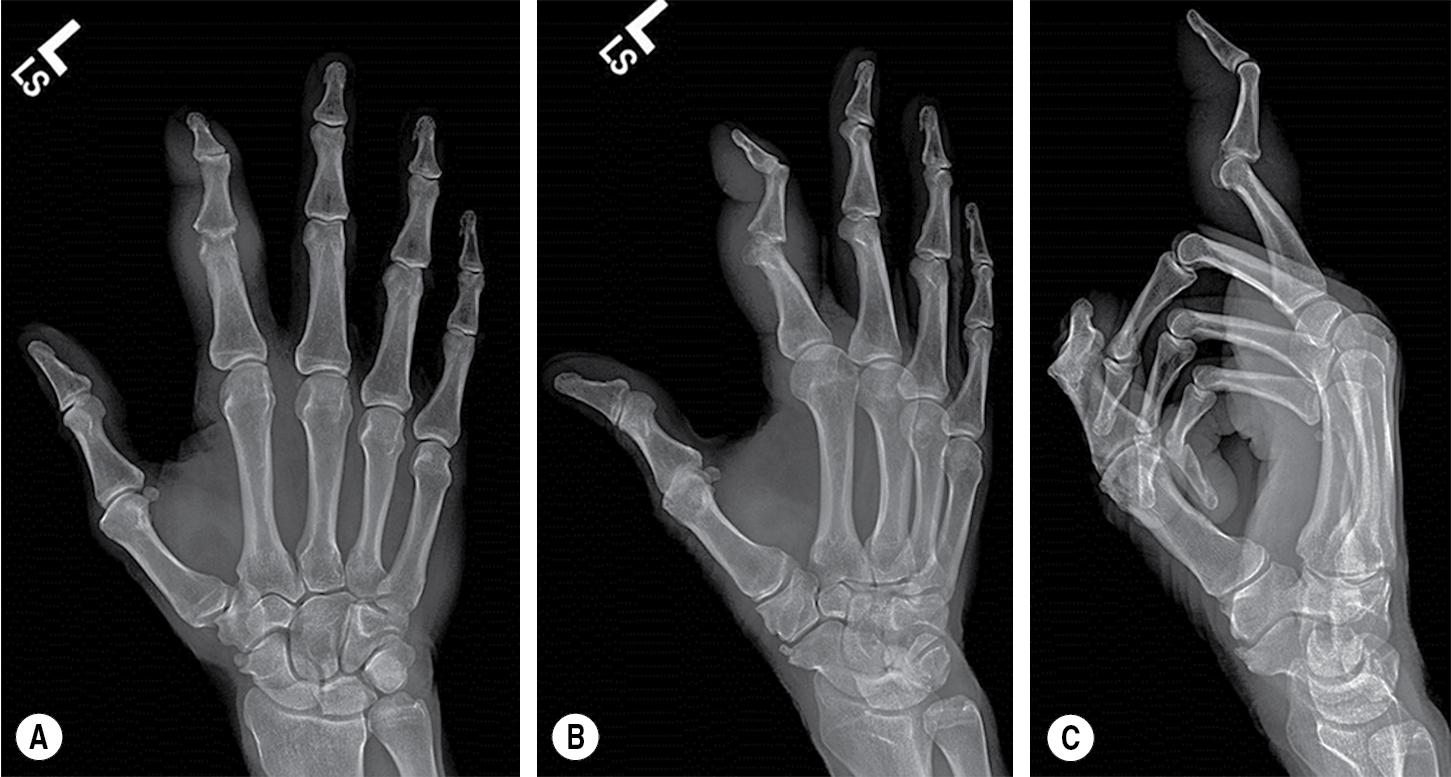 Correction of swan-neck deformity - Clinical Tree