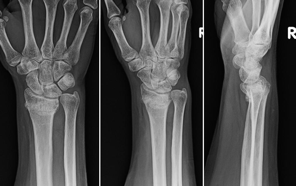 Corrective osteotomy of radius malunion - Clinical Tree