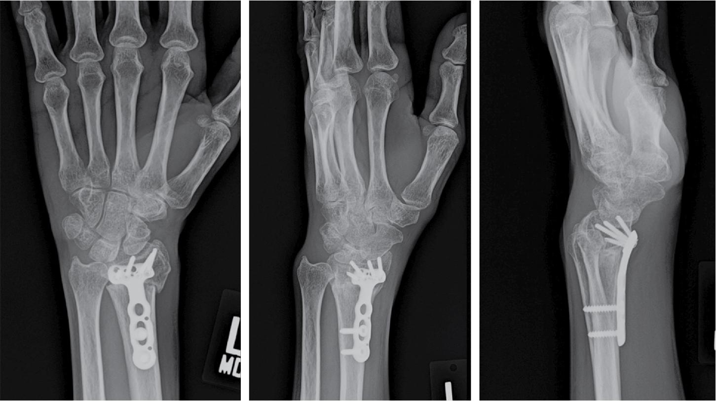 Corrective osteotomy of radius malunion - Clinical Tree