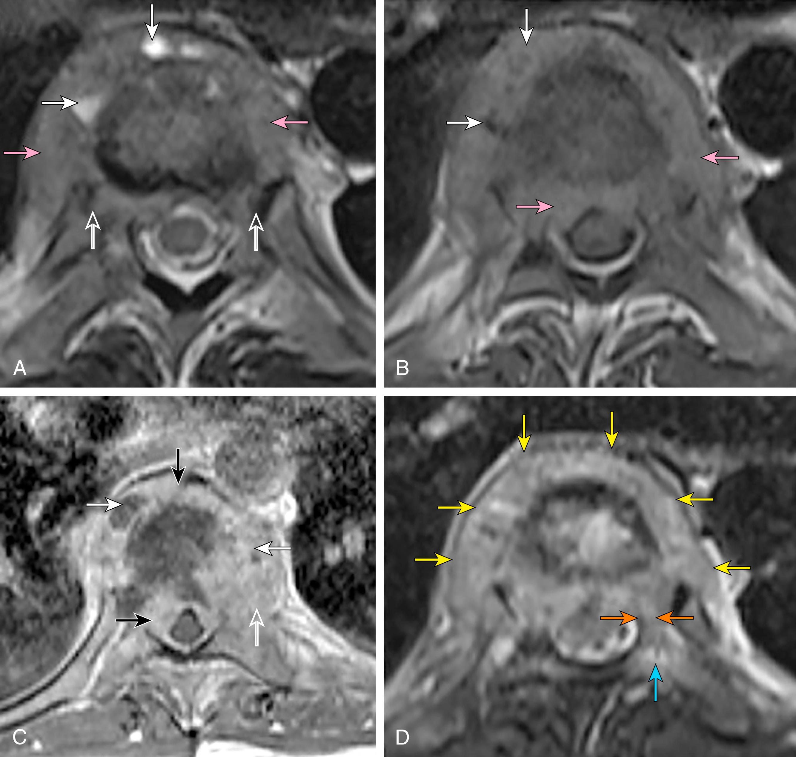 Costovertebral Joint Injection - Clinical Tree