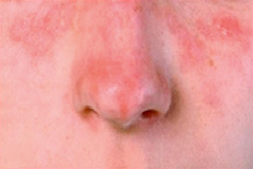 Cutaneous Lupus Erythematosus Clinical Tree