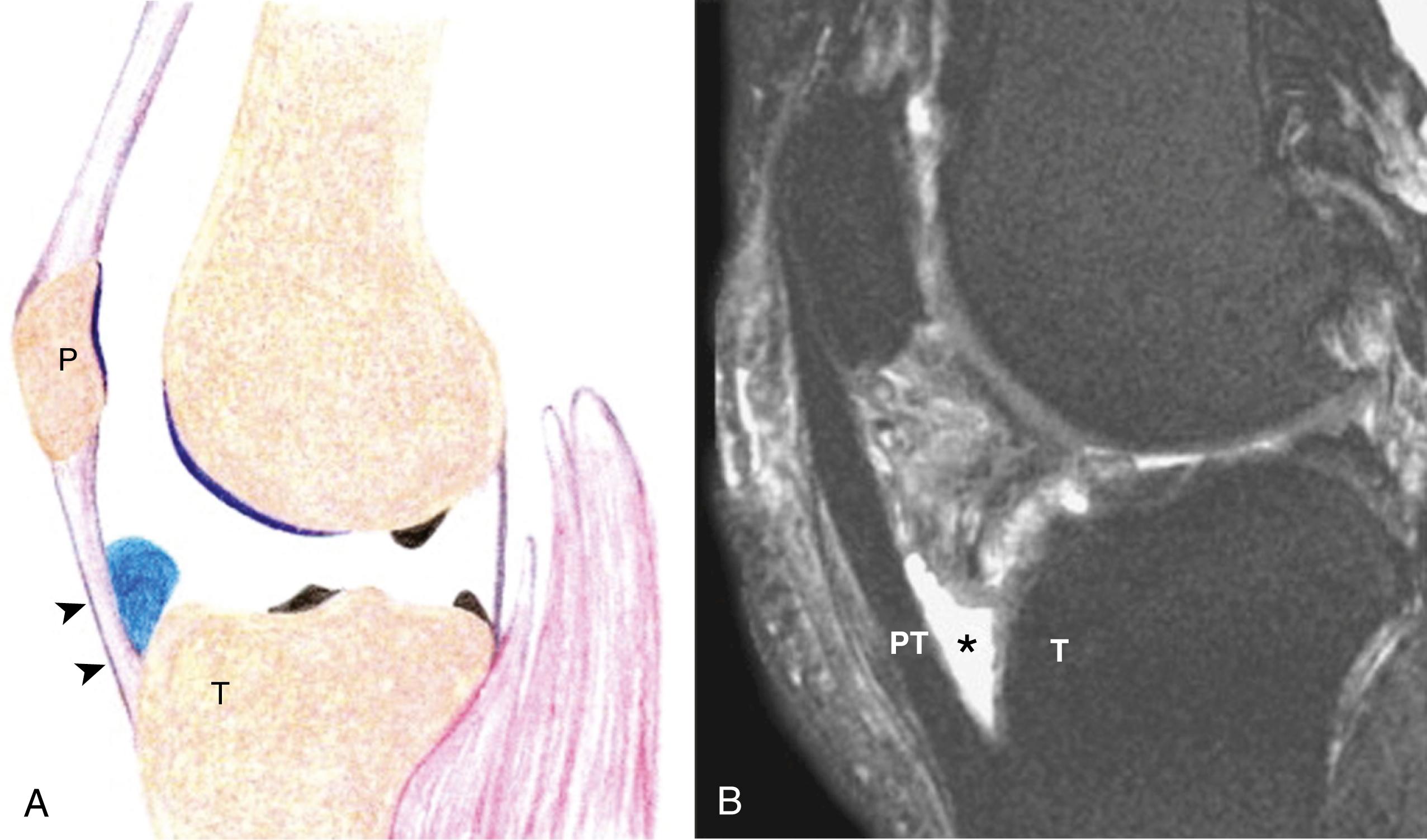 Deep Infrapatellar Bursa Injection - Clinical Tree