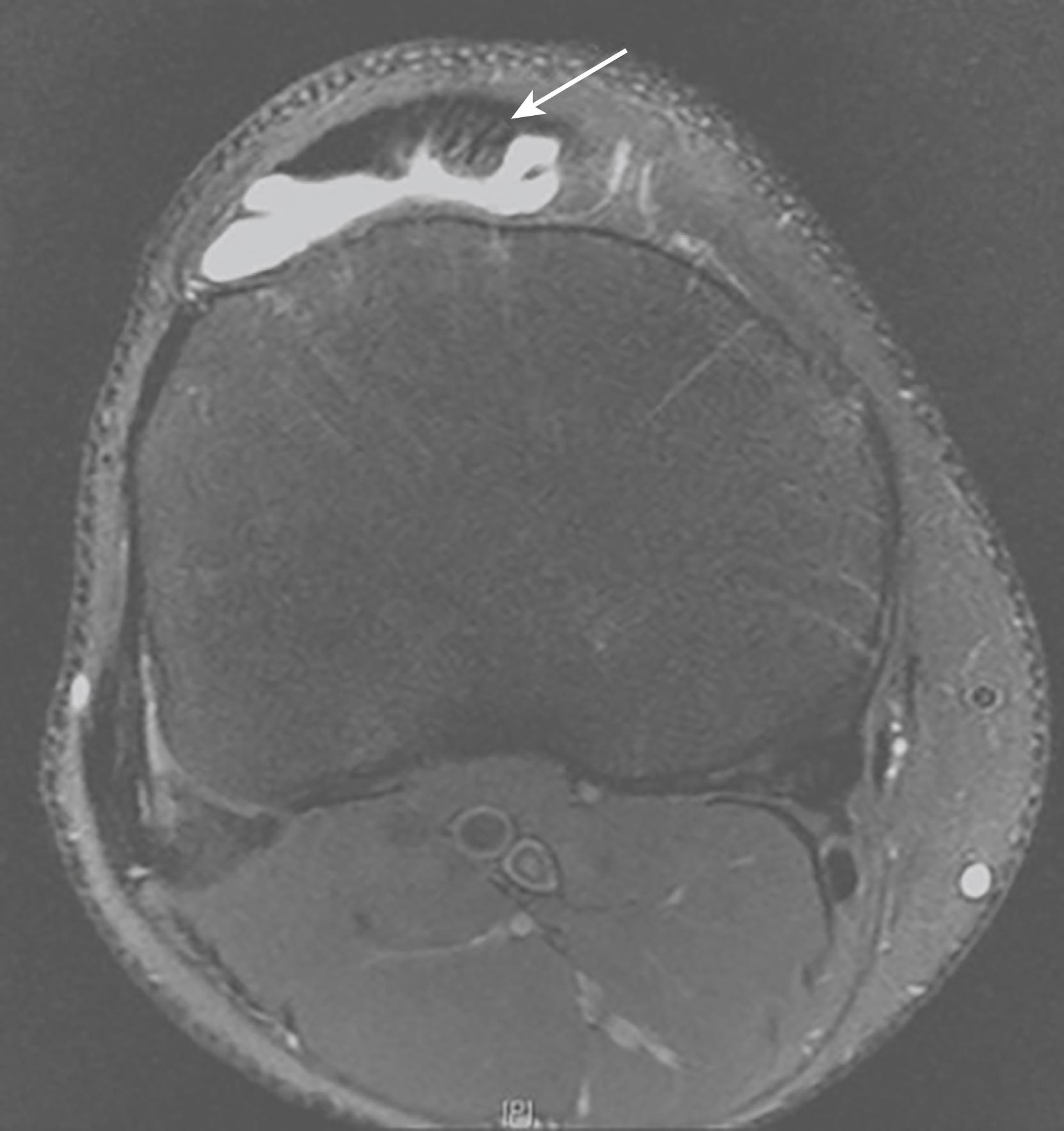 Deep Infrapatellar Bursa Injection - Clinical Tree