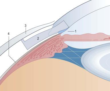 Deep Sclerectomy - Clinical Tree
