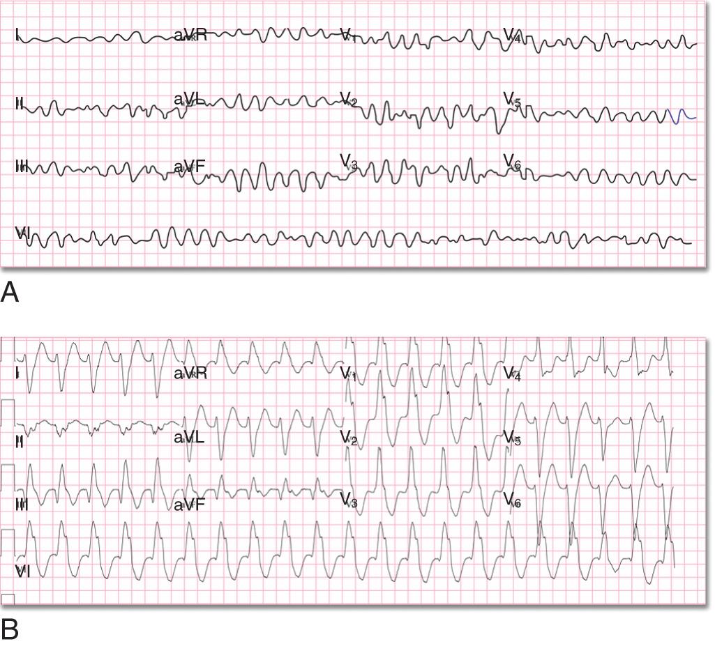 Defibrillation and Cardioversion - Clinical Tree