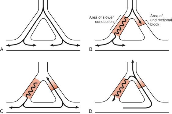Defibrillation and Cardioversion - Clinical Tree