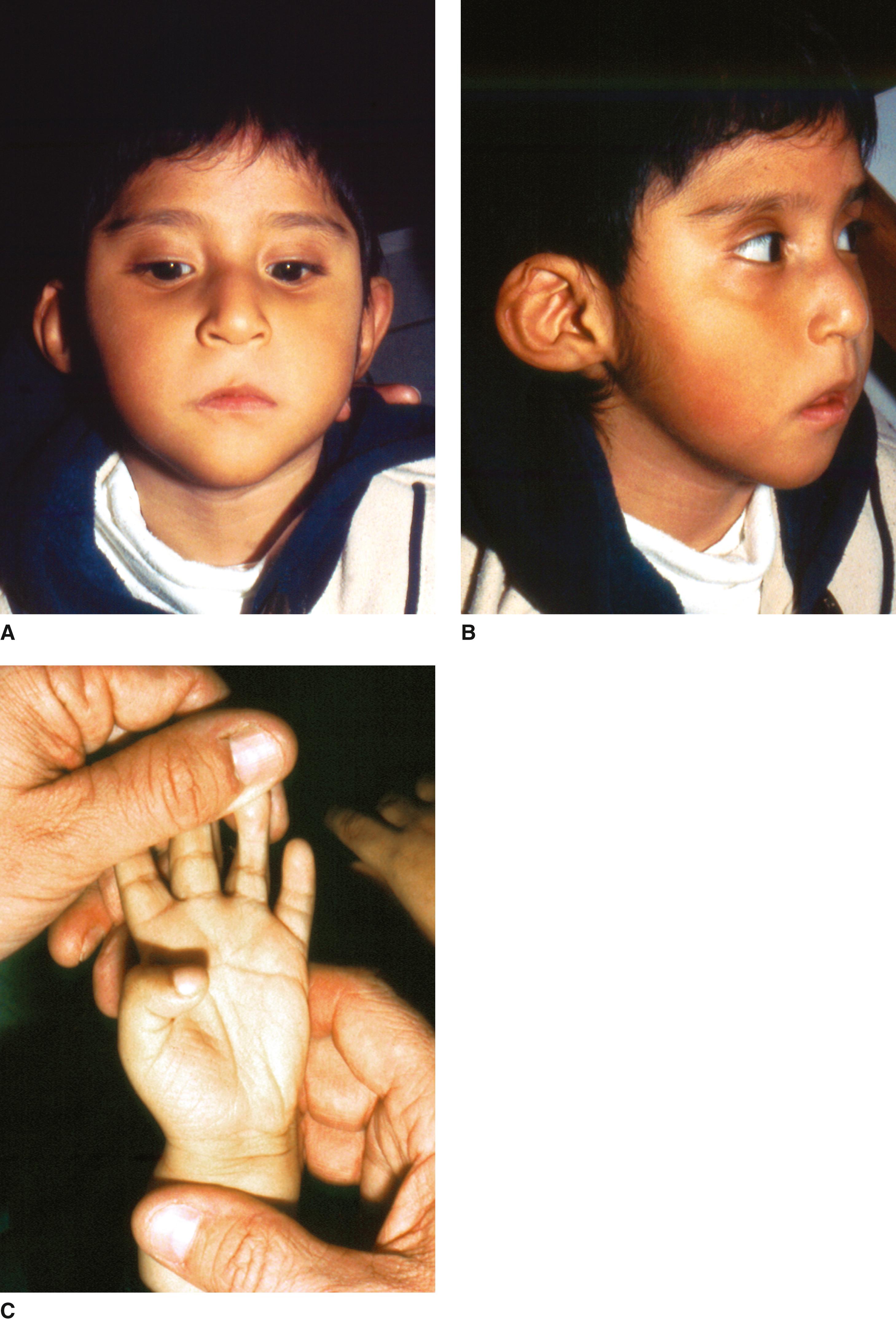 Deletion, Duplication, and Microduplication Syndromes Identifiable ...