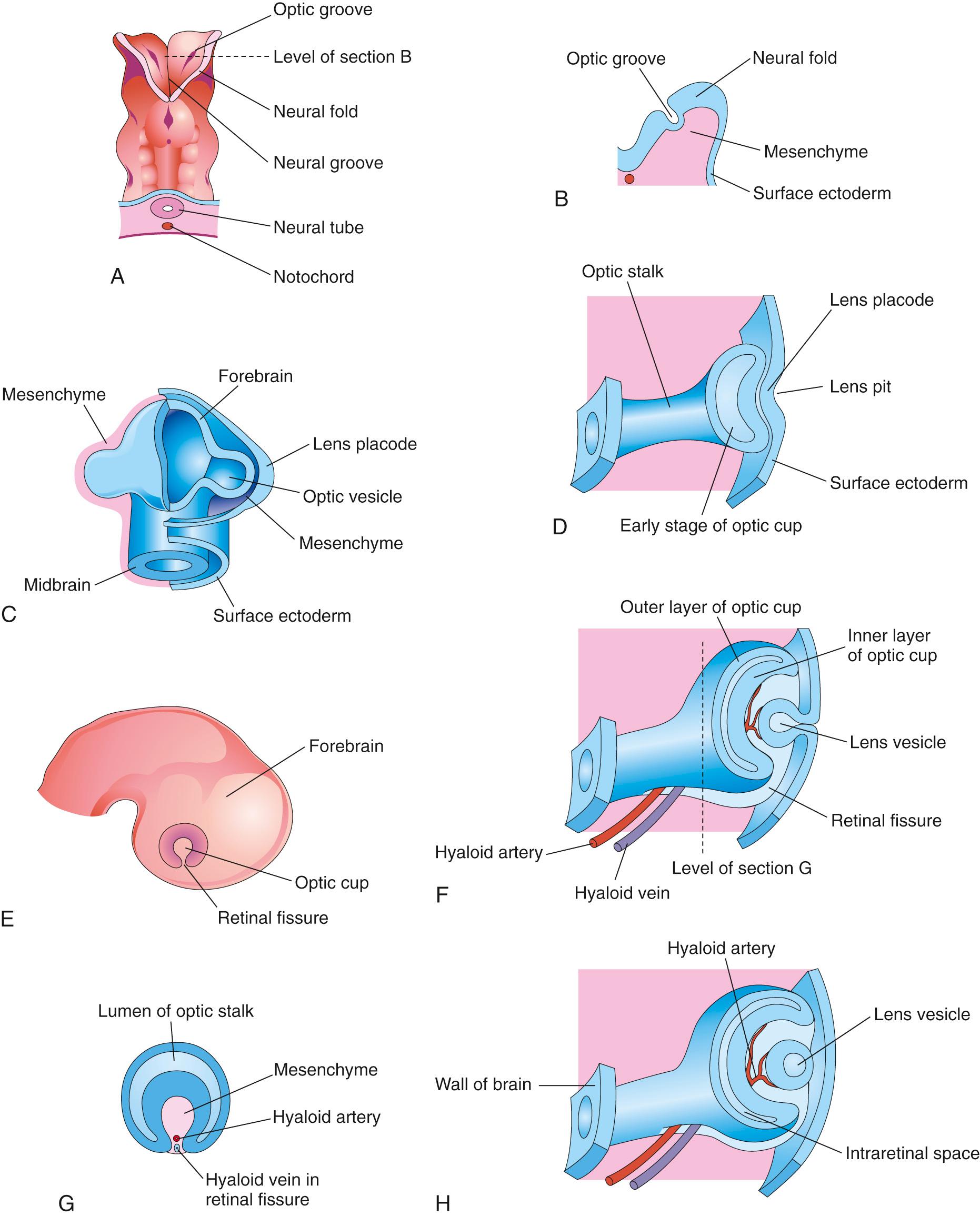 Development of Eyes and Ears - Clinical Tree