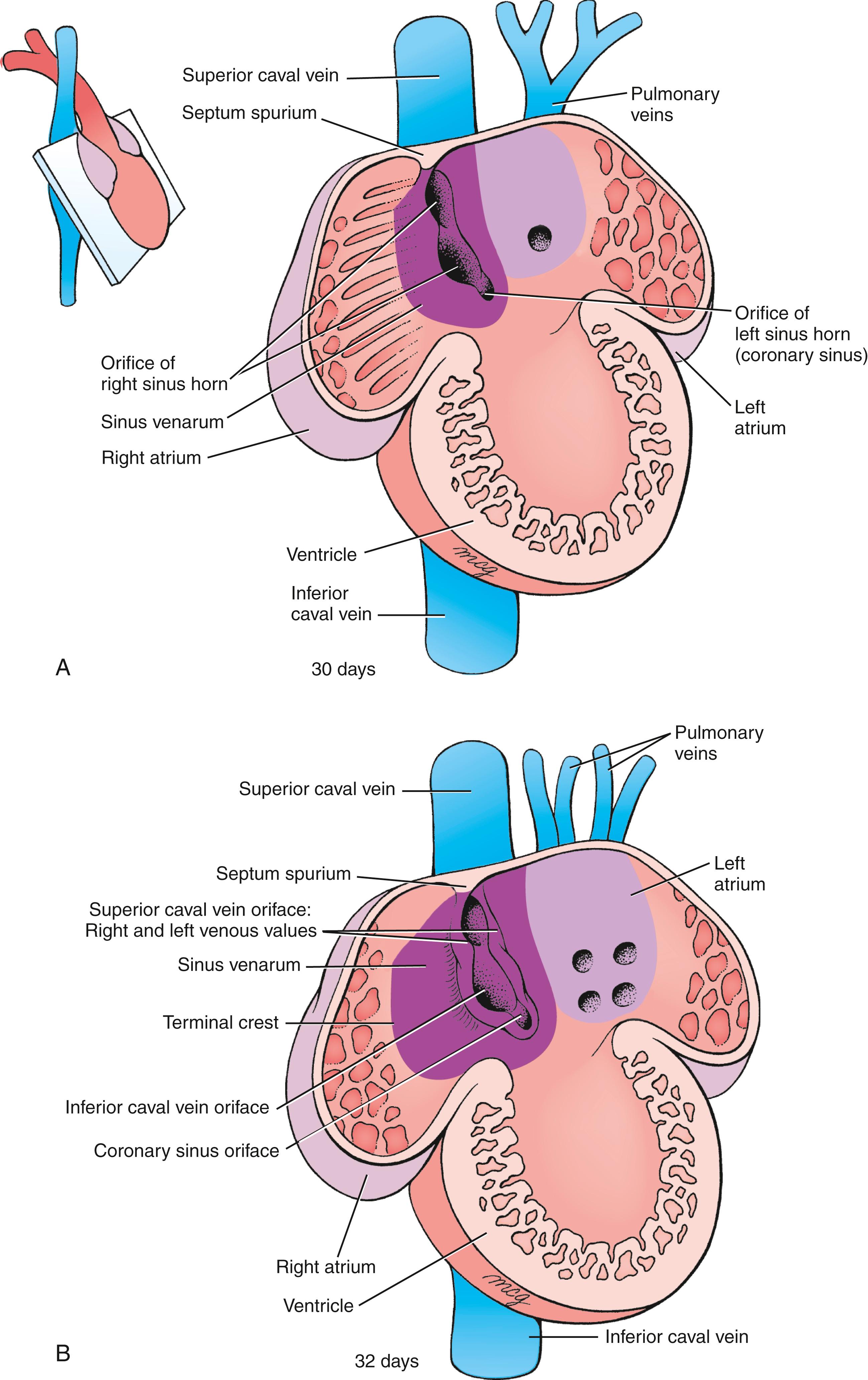 Development of the Heart - Clinical Tree