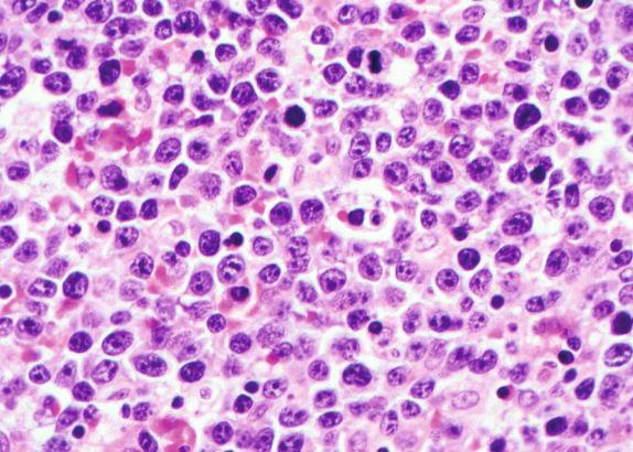 Diffuse Aggressive B-Cell Lymphomas - Clinical Tree