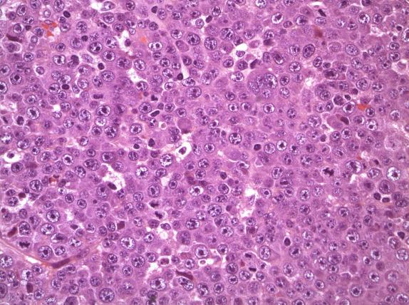 Diffuse Aggressive B-Cell Lymphomas - Clinical Tree