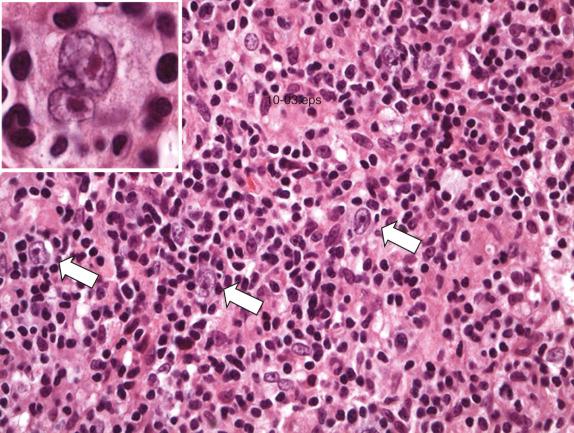 Diffuse Aggressive B-Cell Lymphomas - Clinical Tree