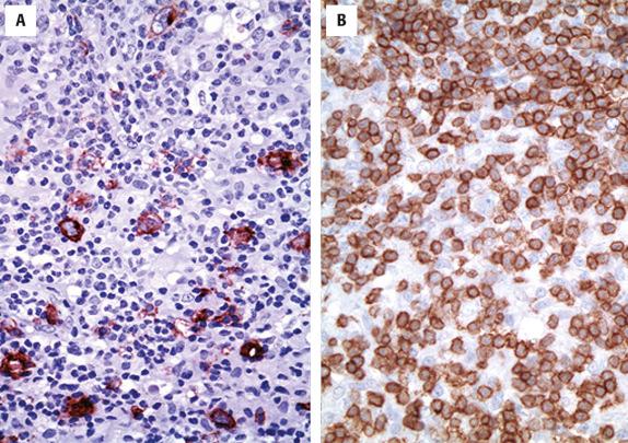 Diffuse Aggressive B-Cell Lymphomas - Clinical Tree