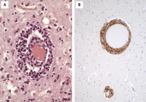 Diffuse Aggressive B-Cell Lymphomas - Clinical Tree