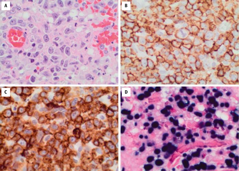 Diffuse Aggressive B-Cell Lymphomas - Clinical Tree