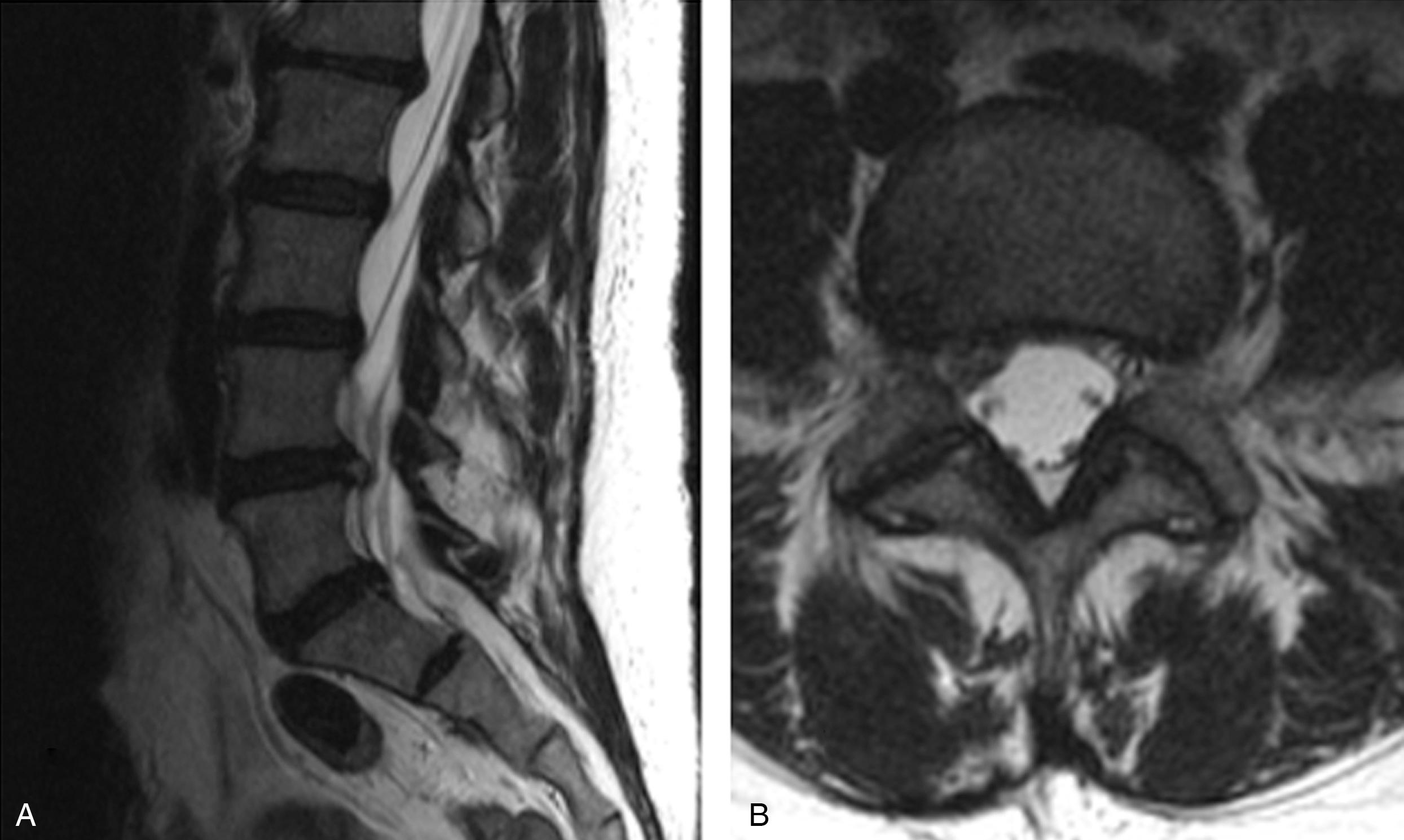 Disc Herniation Primary Recurrent Residual Clinical Tree