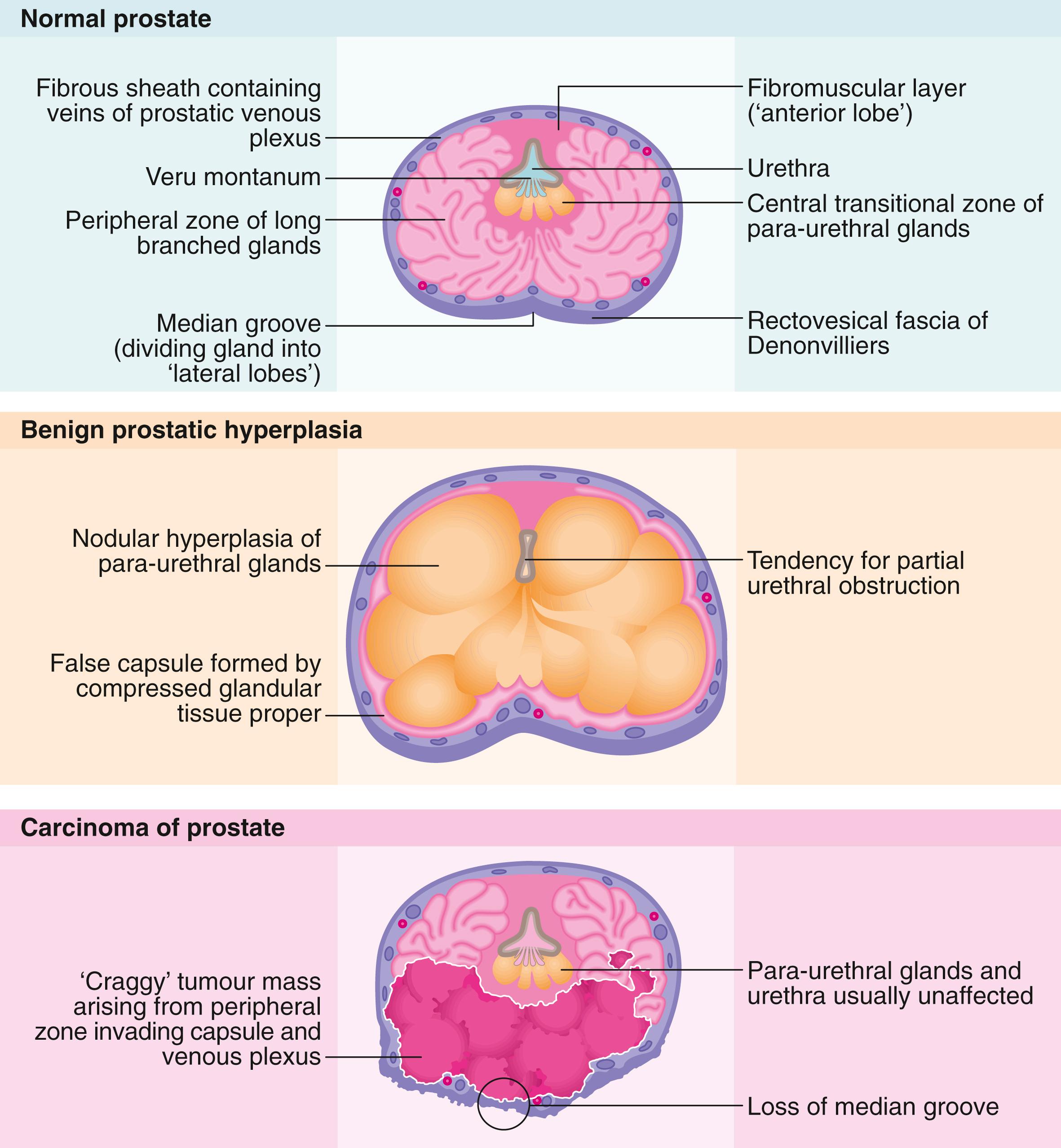 Disorders of the Prostate - Clinical Tree