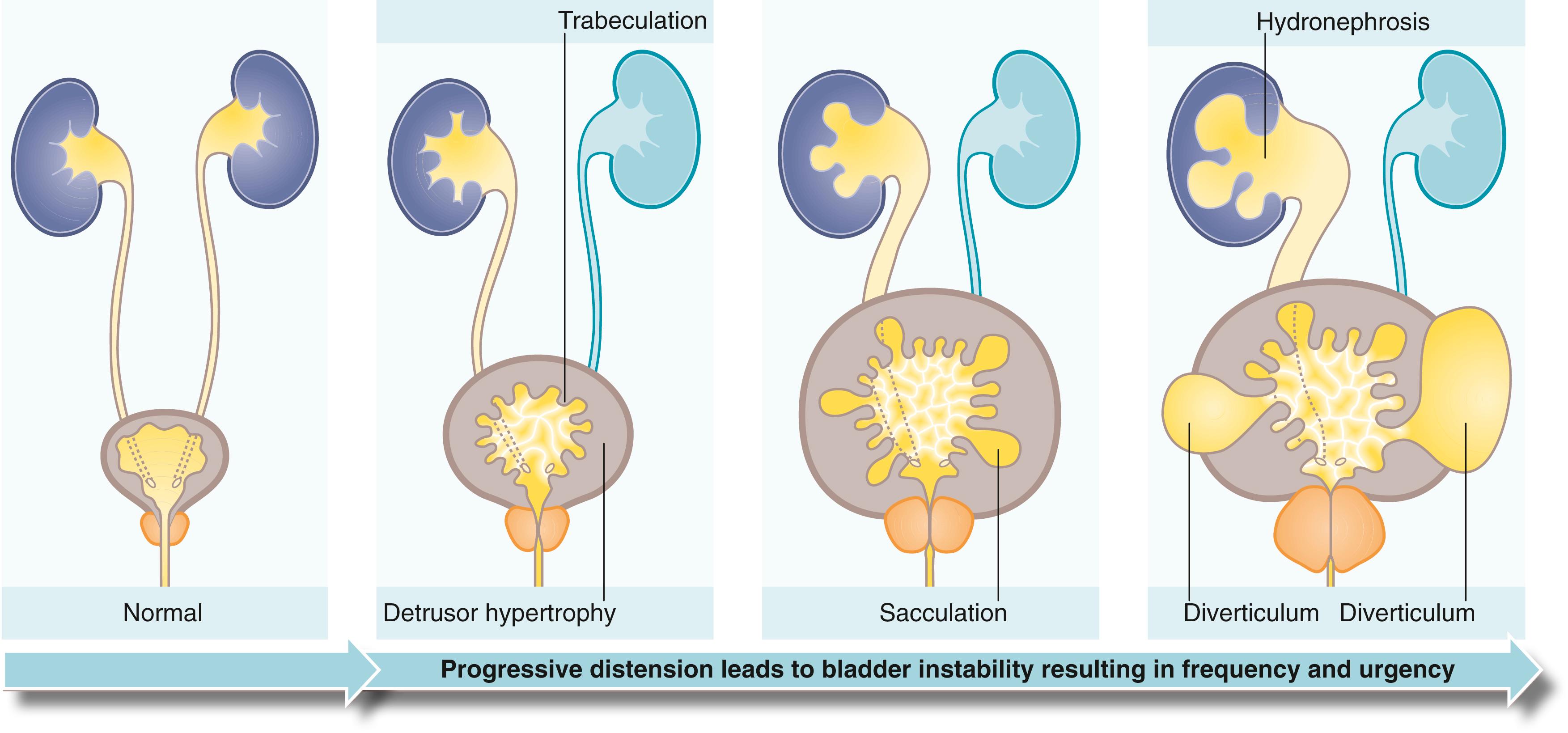 Disorders of the Prostate - Clinical Tree
