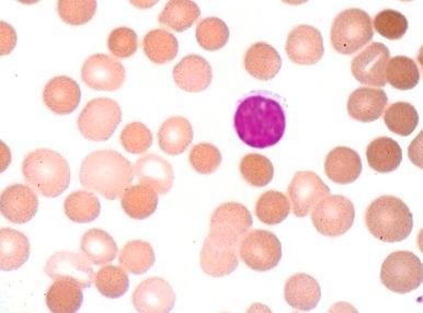 Disorders of the Red Cell Membrane - Clinical Tree