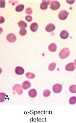 Disorders of the Red Cell Membrane - Clinical Tree