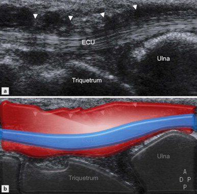 Disorders of the Wrist: Ulnar Side - Clinical Tree