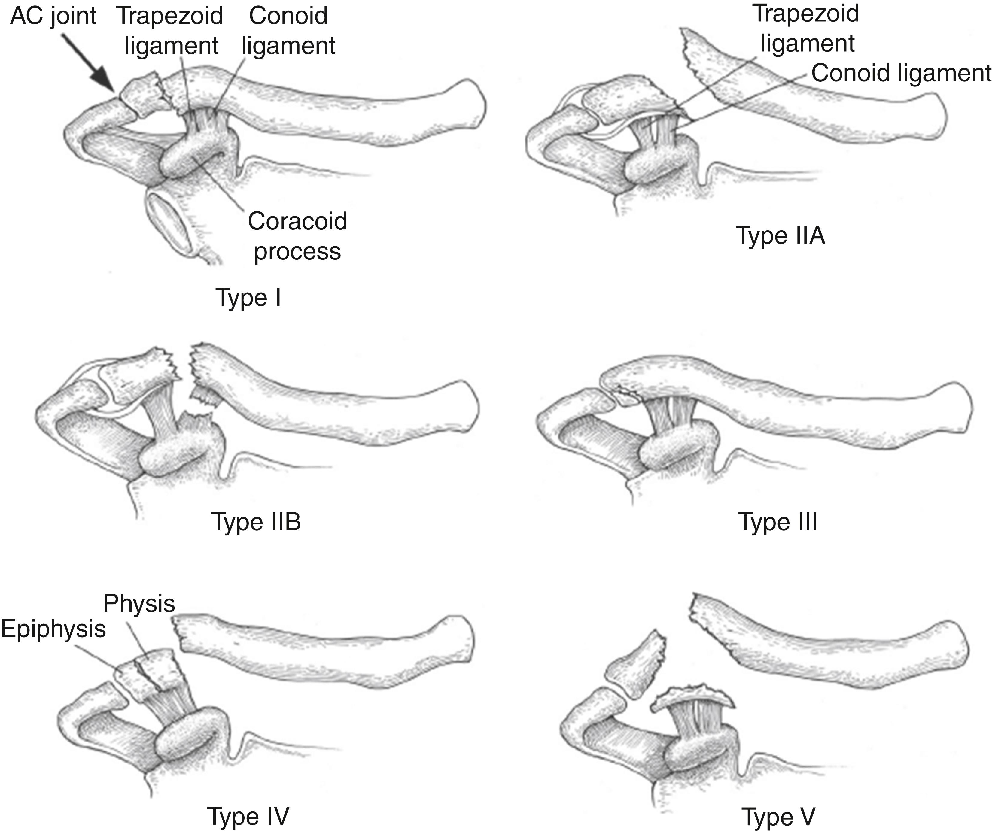 Distal Clavicle Fractures - Clinical Tree