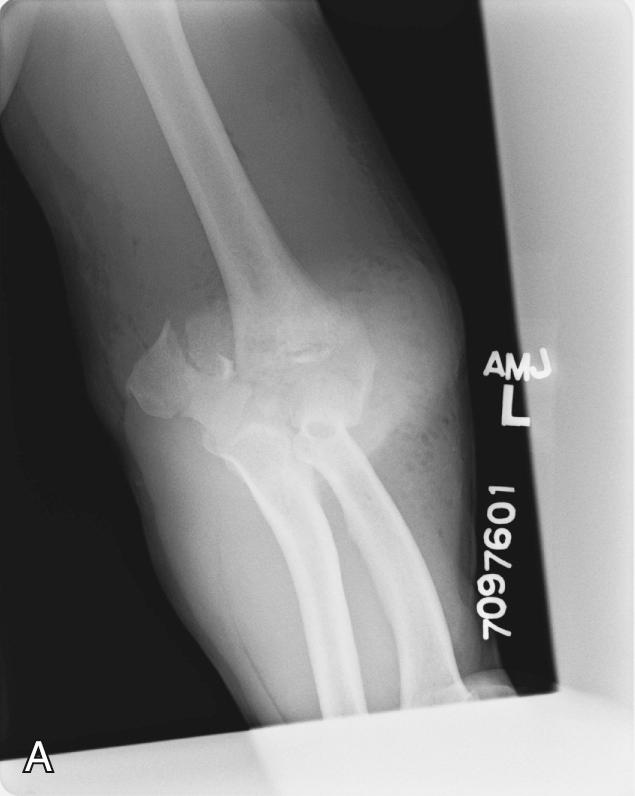 Distal Humerus Fractures: Fractures of the Columns With Articular ...