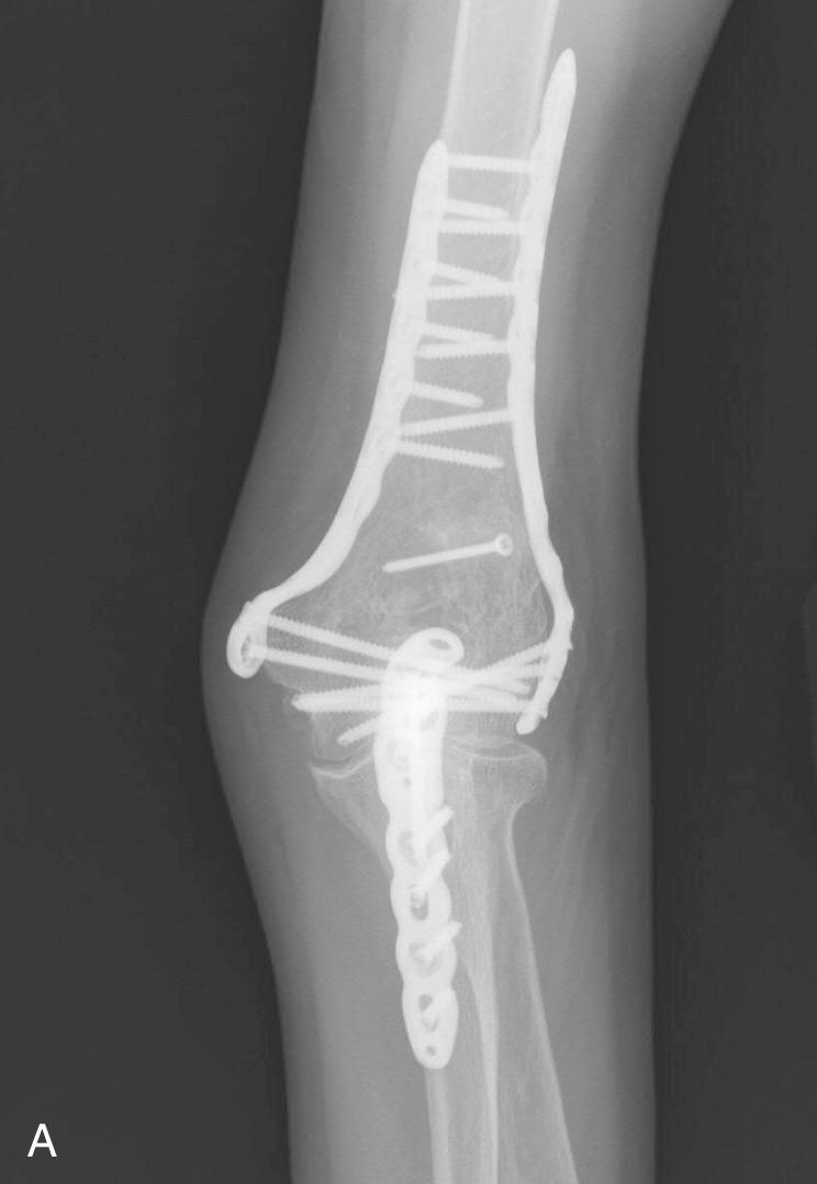 Distal Humerus Fractures: Fractures of the Columns With Articular ...