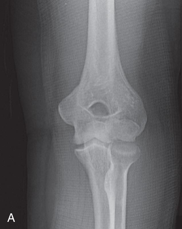 Distal Humerus Fractures: Isolated Fracture of the Capitellum ...