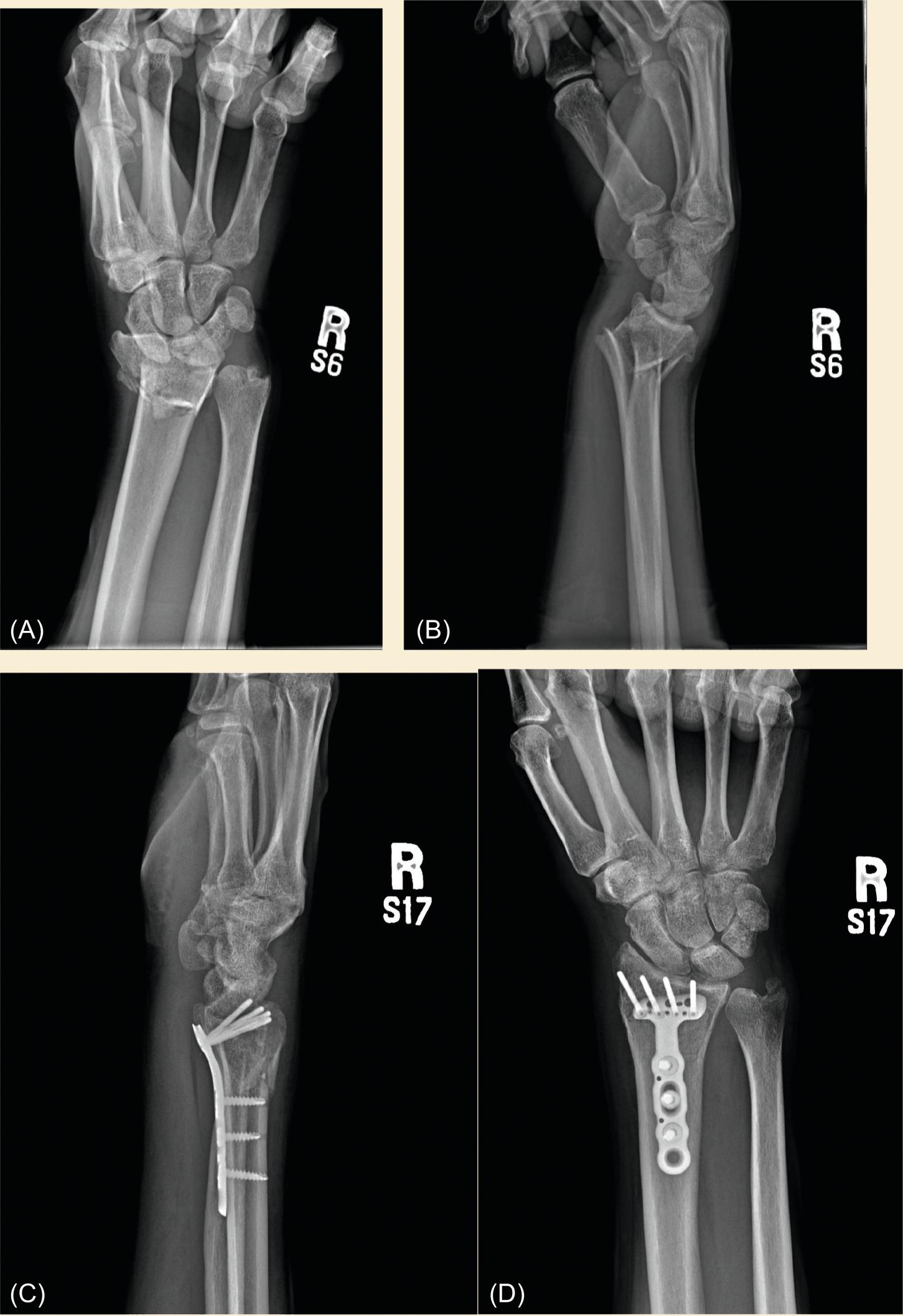 Distal Ulnar Fractures Concomitant With Distal Radius Fractures ...