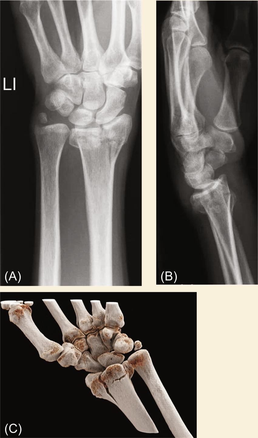 Distal Ulnar Fractures Concomitant With Distal Radius Fractures ...