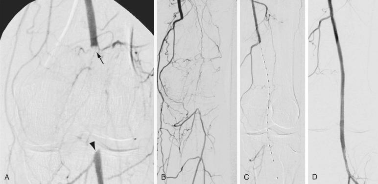 Embolectomy/Thrombectomy – Arterial - Clinical Tree