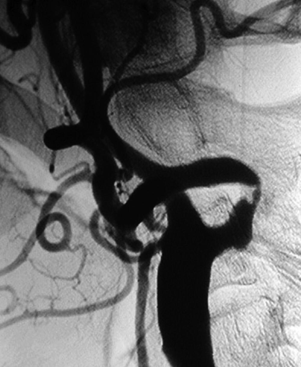 Embolic Protection Issues - Clinical Tree