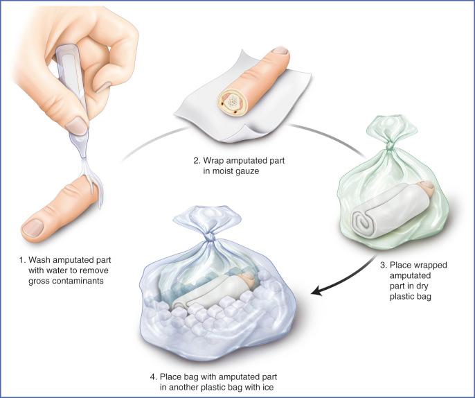 Emergency Microsurgery of the Upper Extremity - Clinical Tree