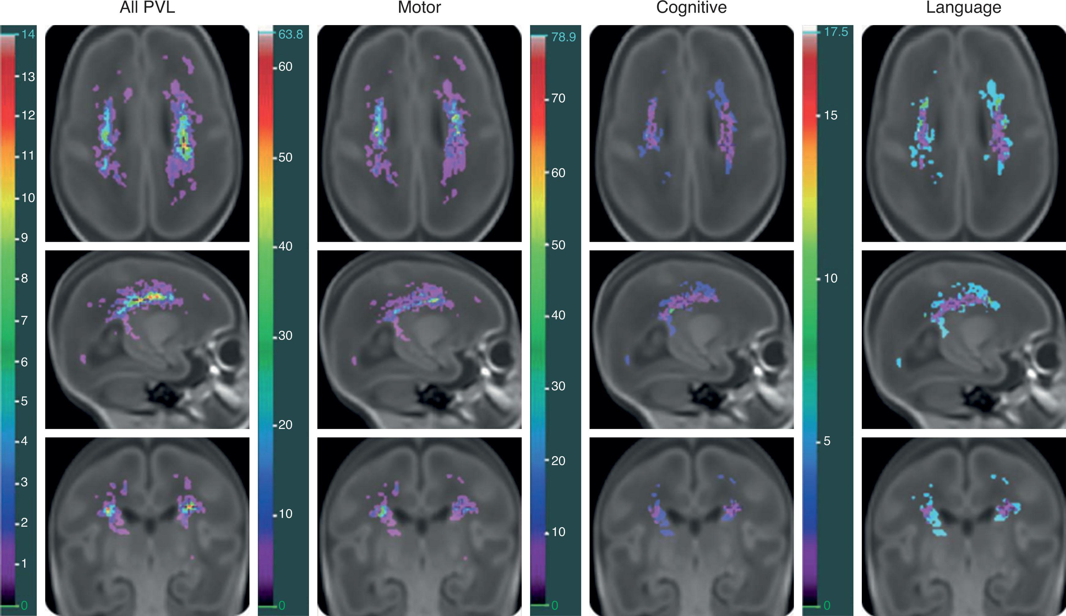 Encephalopathy of the Preterm—Clinical Aspects - Clinical Tree