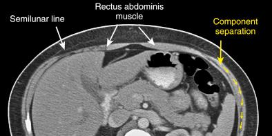 Endoscopic Component Separation - Clinical Tree