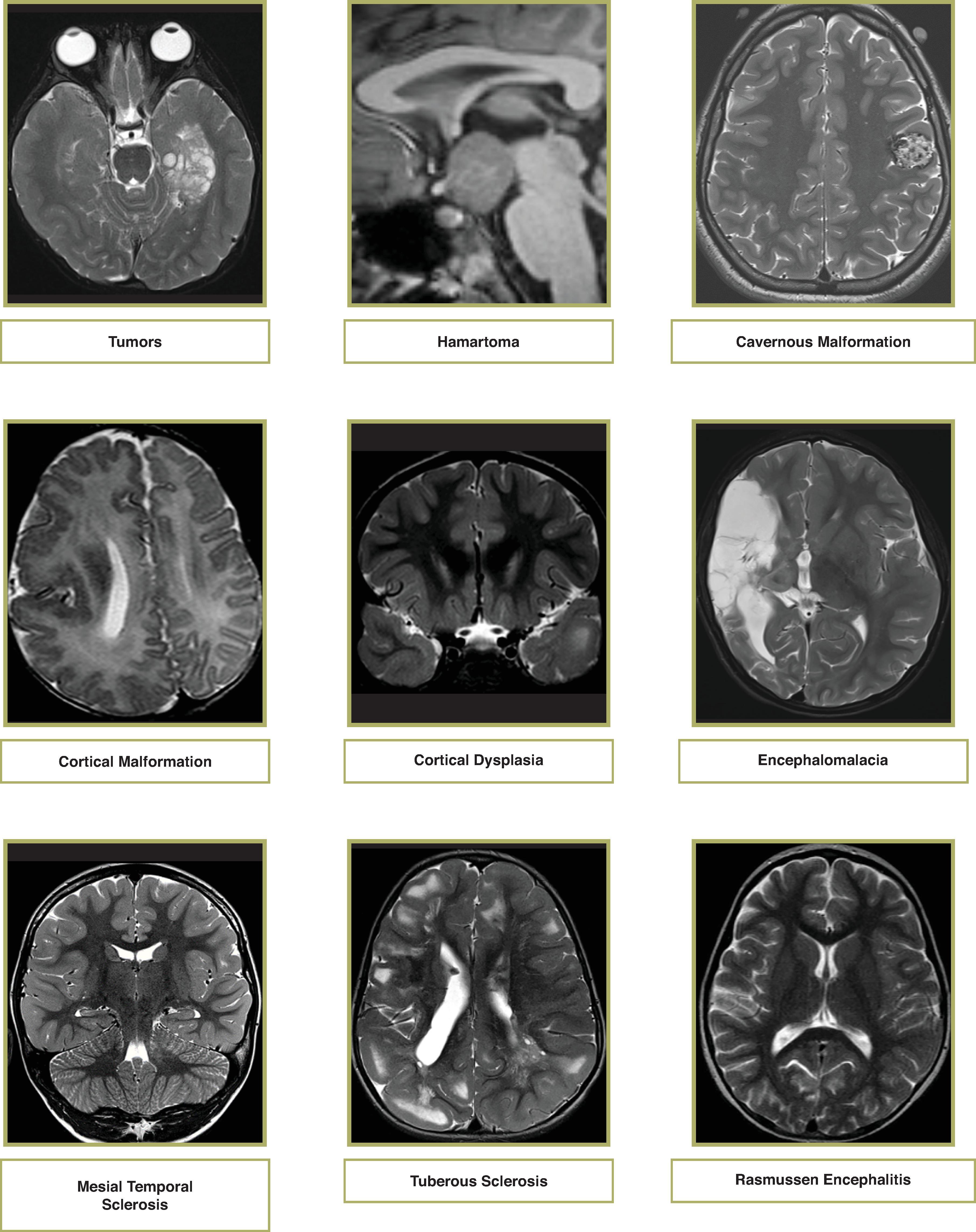 Epilepsy – Clinical Tree