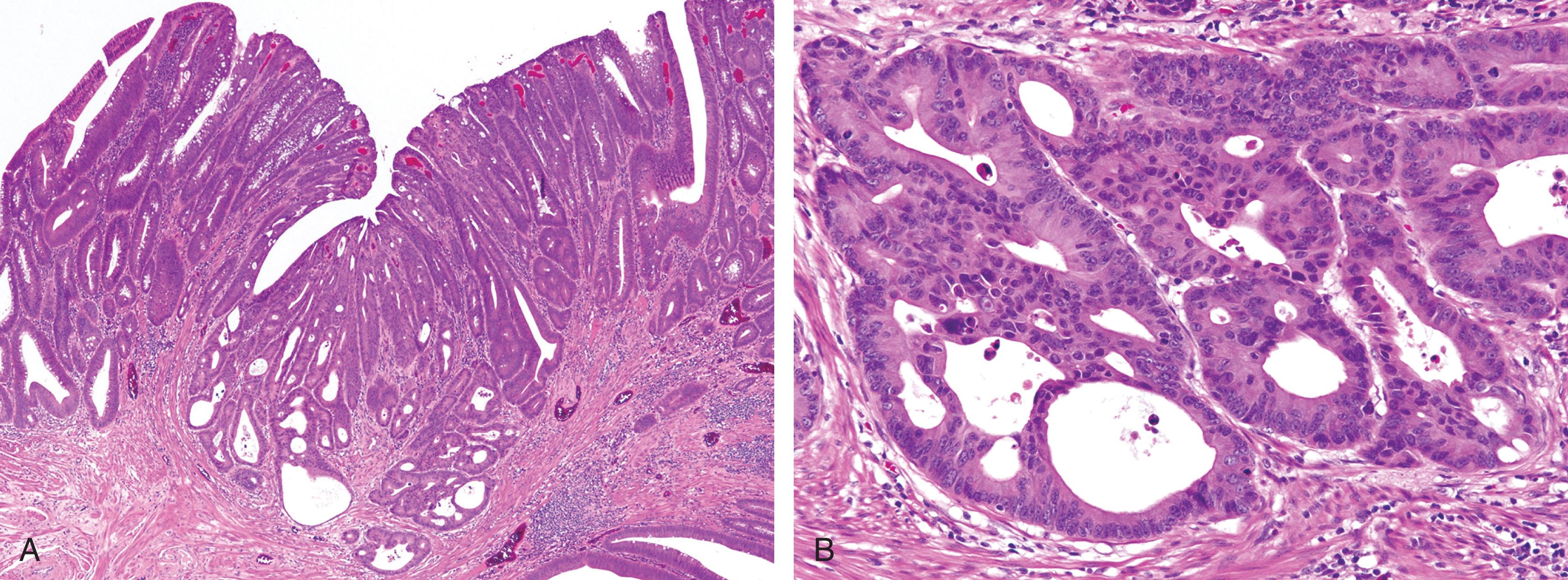 Epithelial Neoplasms of the Colorectum - Clinical Tree