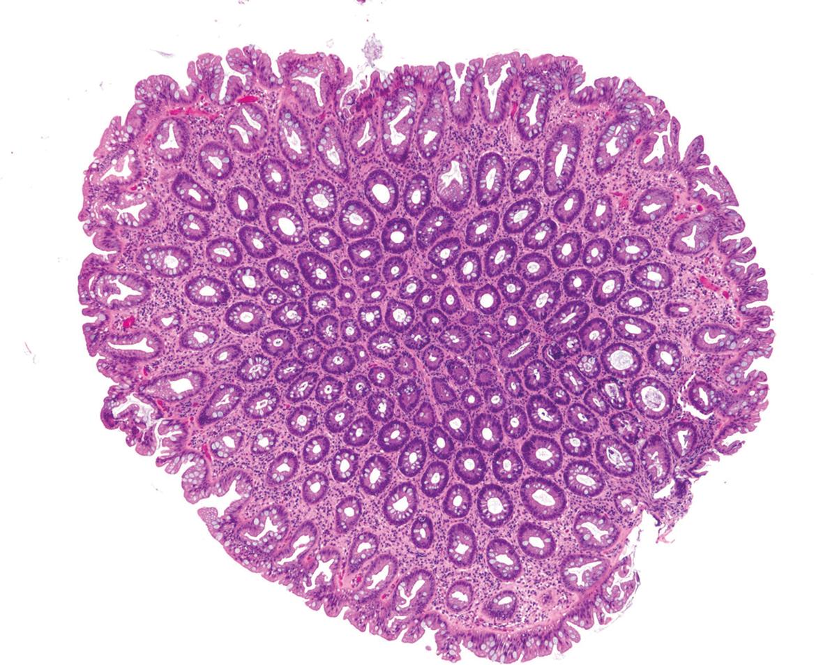 Epithelial Neoplasms of the Colorectum - Clinical Tree