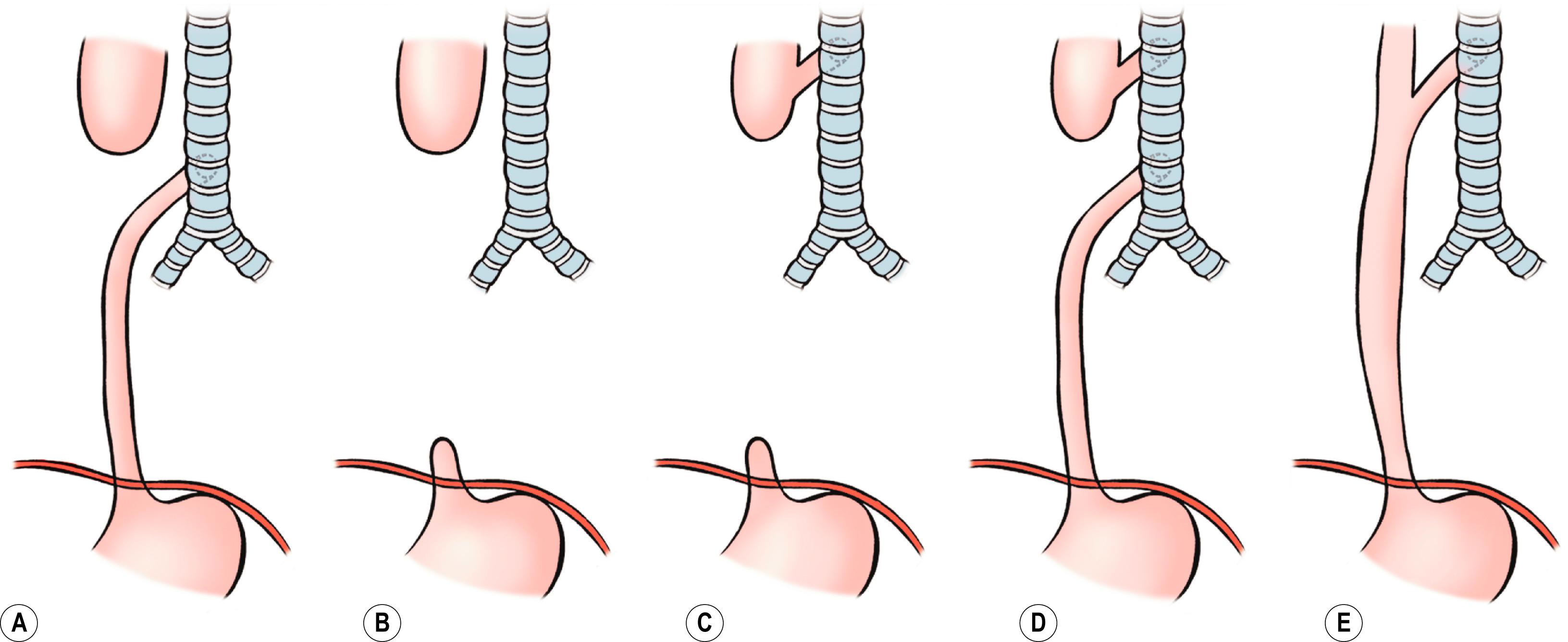 Esophageal Atresia And Tracheoesophageal Fistula Malformations