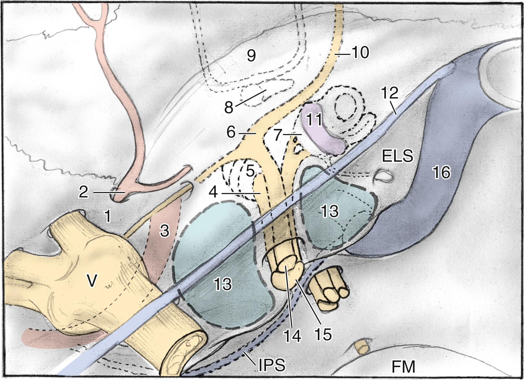 Extended Middle Cranial Fossa Approach - Clinical Tree