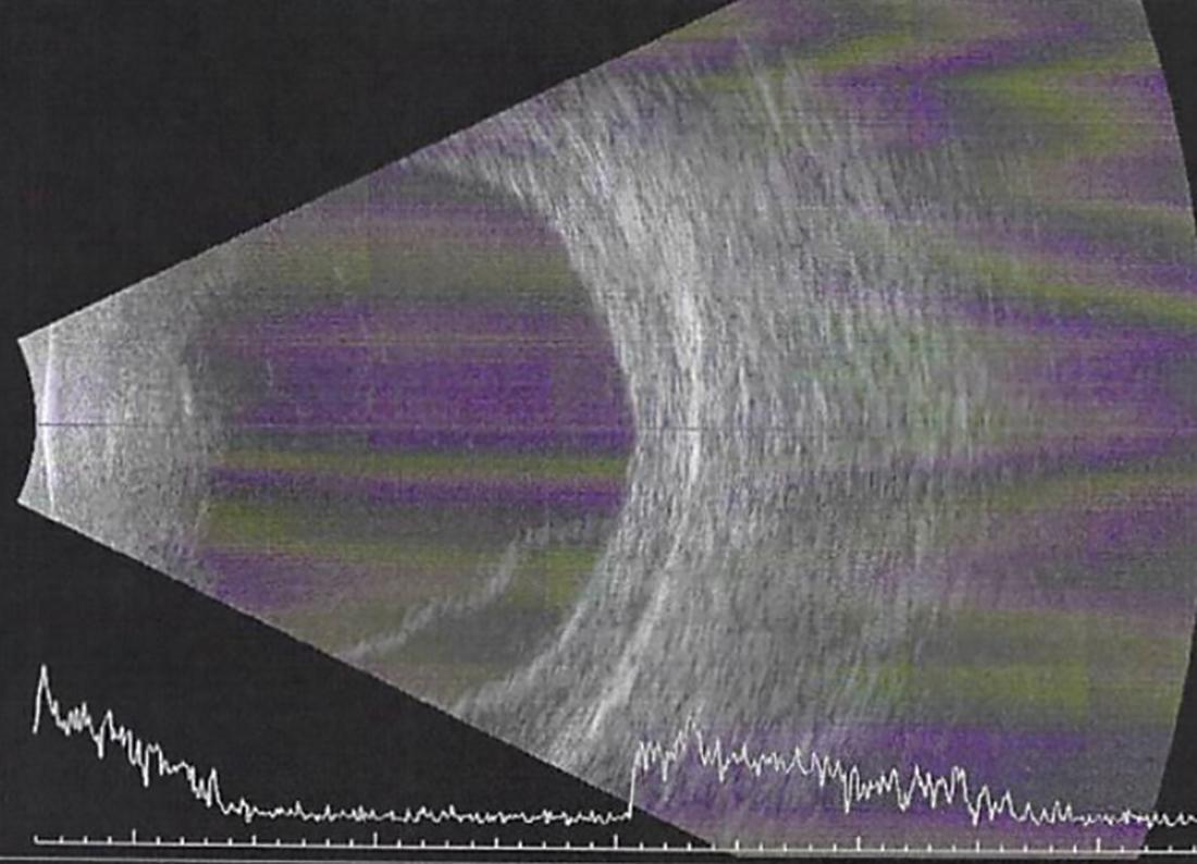 Exudative Retinal Detachment - Clinical Tree