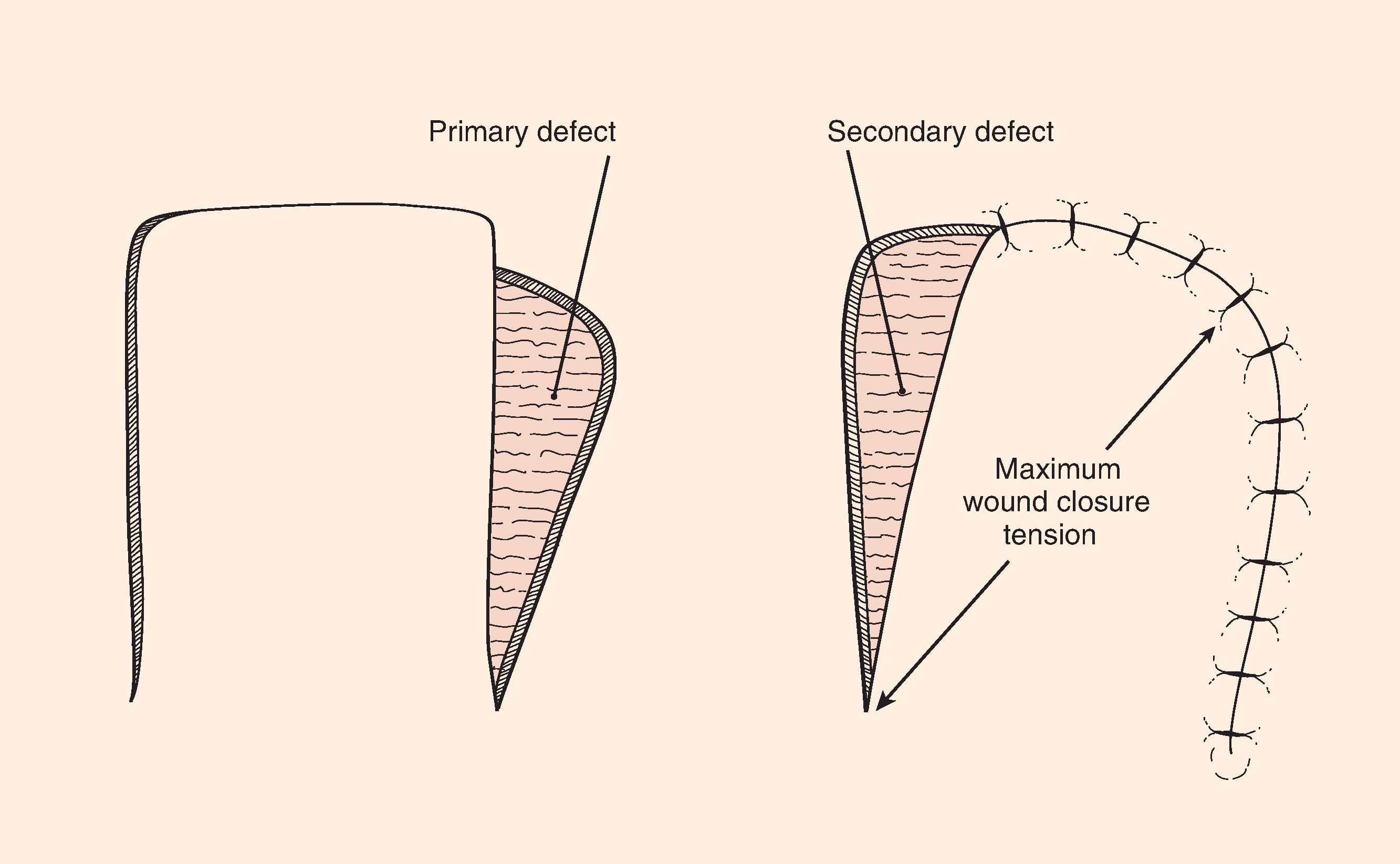 FLAP CLASSIFICATION AND DESIGN - Clinical Tree
