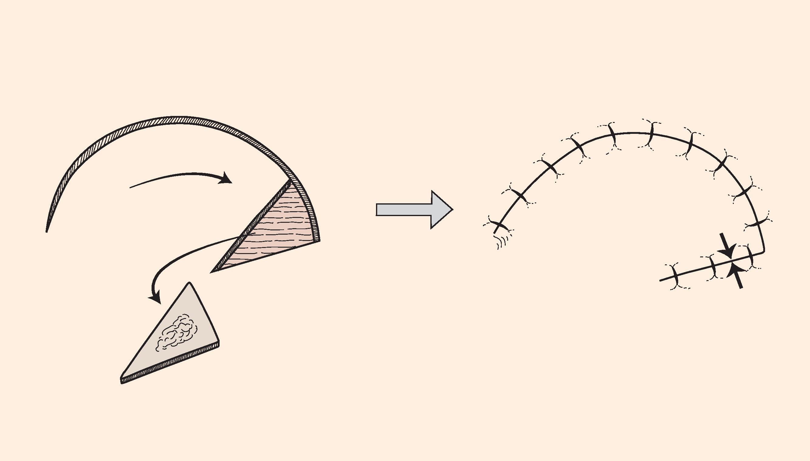 FLAP CLASSIFICATION AND DESIGN - Clinical Tree