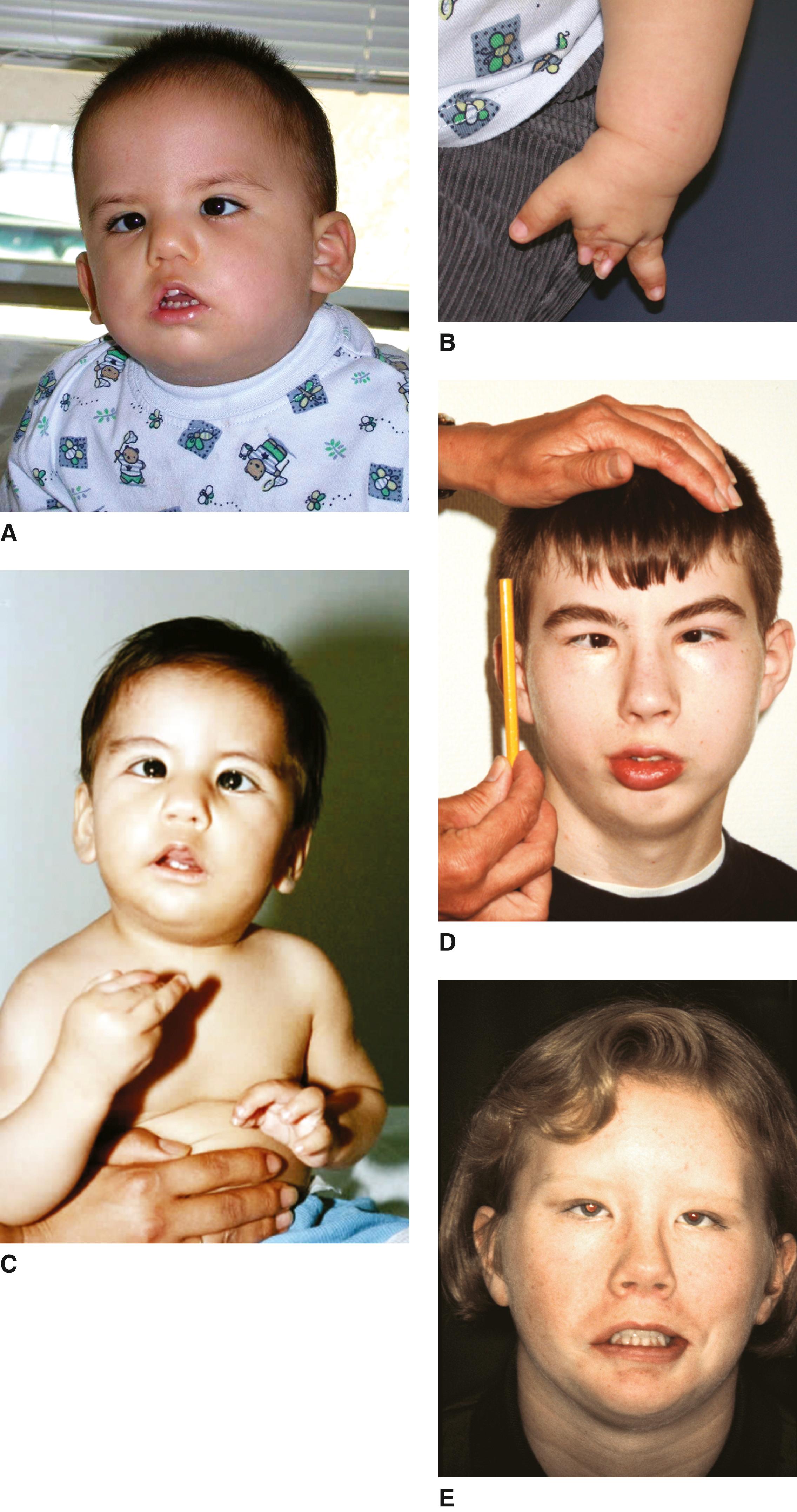 Facial Defects as Major Feature - Clinical Tree